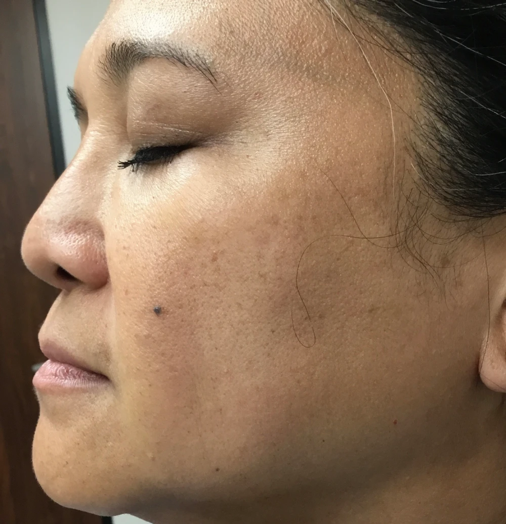 Dermaplaning Treatment | Skin Joy Dermatology - Austin, TX