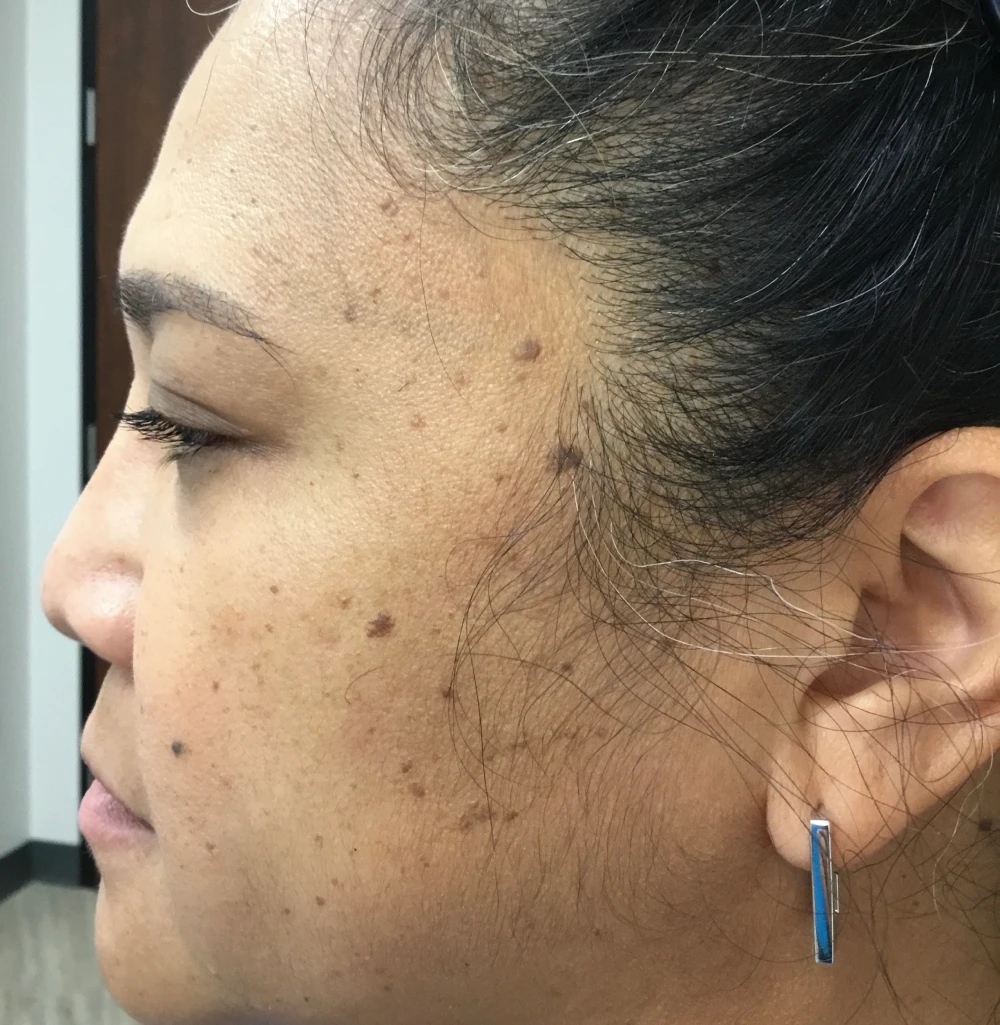 Dermaplaning Treatment | Skin Joy Dermatology - Austin, TX