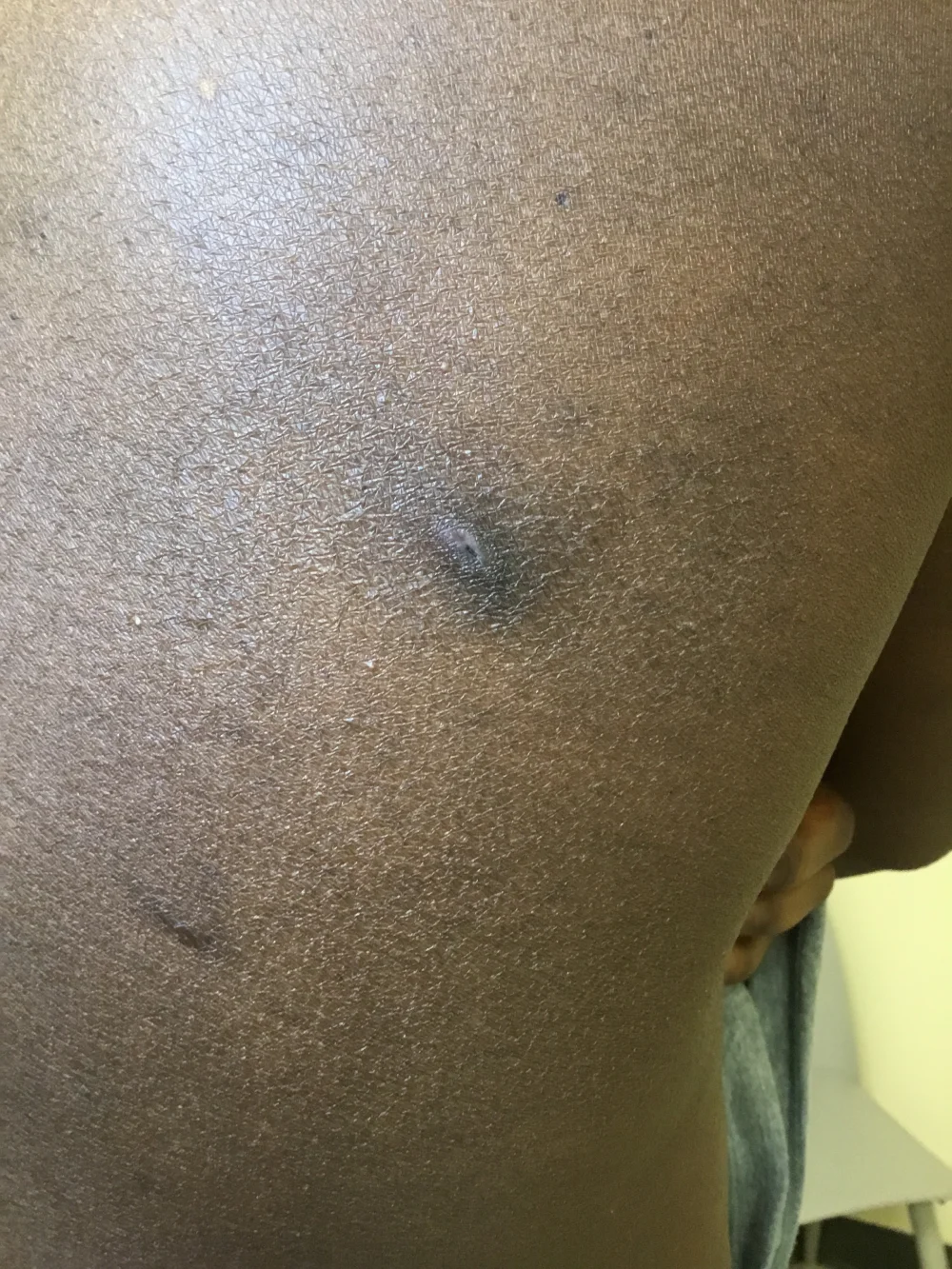 Cyst Removal | Austin Dermatologist - Skin Joy Dermatology