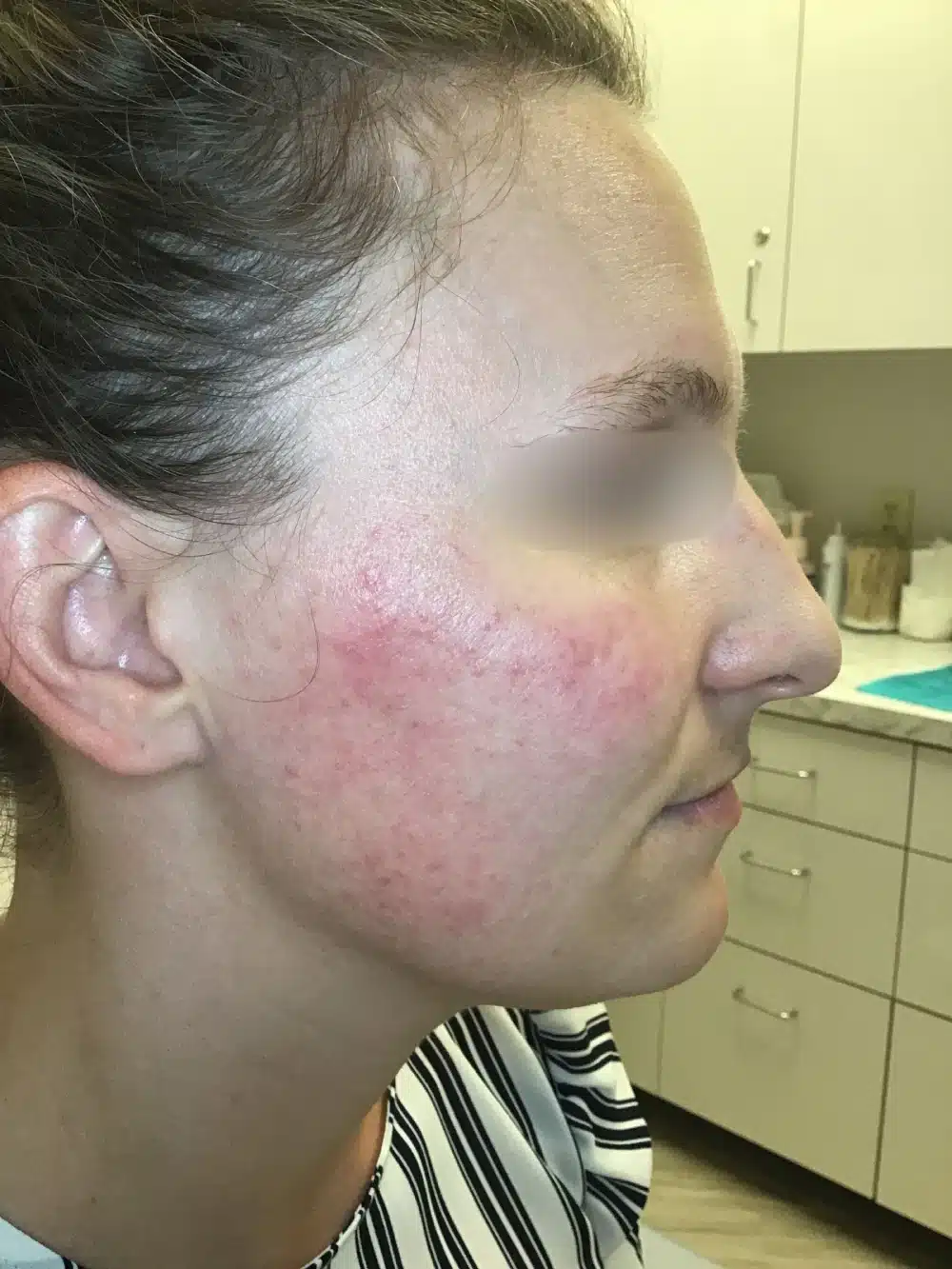 Rosacea | Nature of Skin | Austin Dermatologist - Saya Obayan MD, FAAD